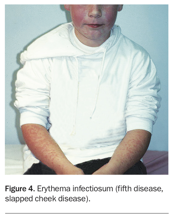 Viral exanthems: unravelling viral rashes | Medicine Today Viral exanthems: unravelling viral rashes | Medicine Today
